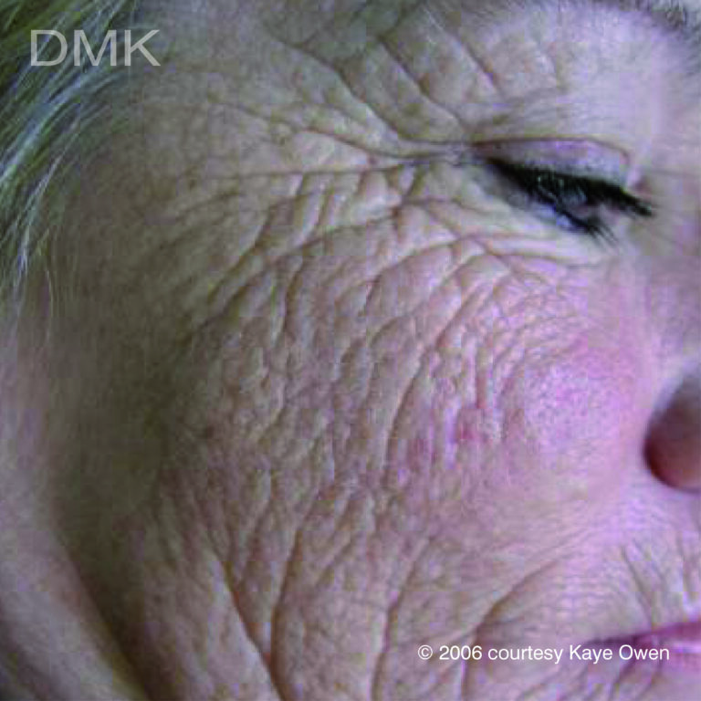 DMK Skin Revision Treatments - Vital Effect